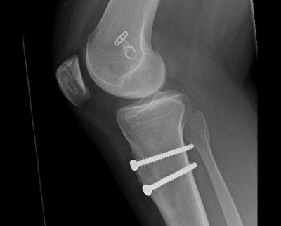 Orthopaedic Surgery Services | Tamar Valley Orthopaedics - Launceston
